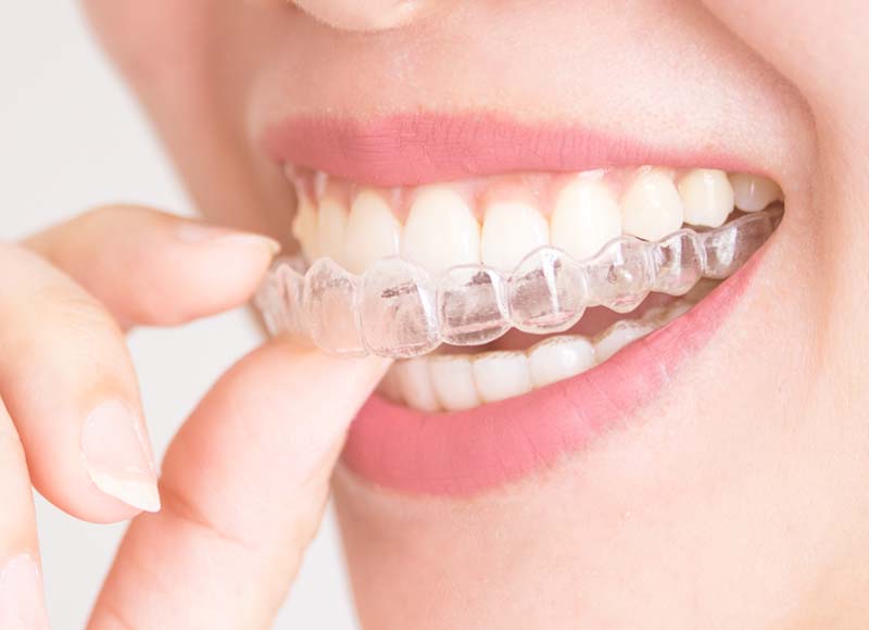 Orthodontic Appliances