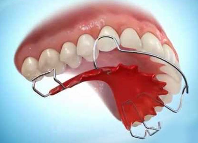 Orthodontic Appliances