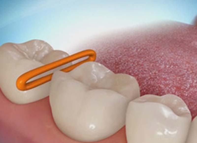 Orthodontic Appliances